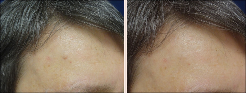 Actinic Keratosis Causes And Treatment Photo By Certified Doctor in Chicago