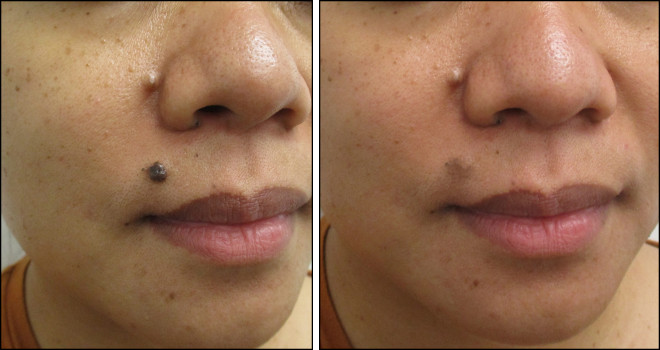 Mole Removal Before And After