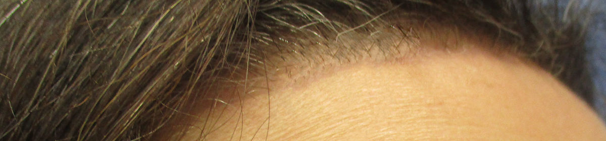 Forehead Lift: Brow Lift Scar After Pictures | Brow Lift Scar Treatment ...