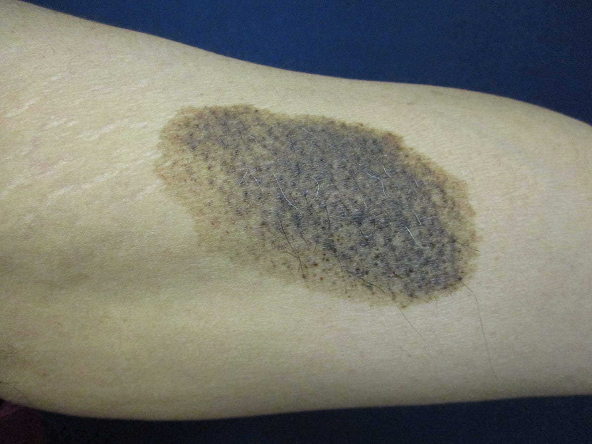 Laser Mole Removal:Treatment Chicago Mole Removal | Mole Removal ...