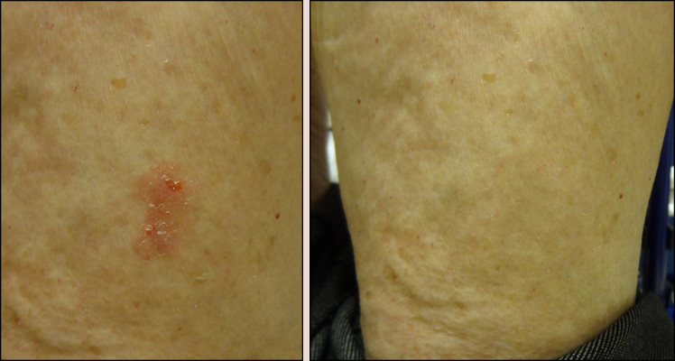 Actinic Keratosis Causes And Treatment Photo By Certified Doctor in Chicago