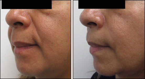 Collagen & Hyaluronic Acid Injections | Before and After Pictures ...