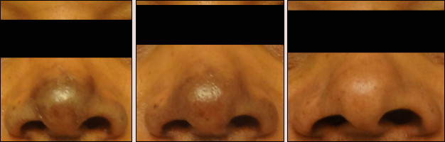 Laser Mole Removal in Chicago: Before and After Photos