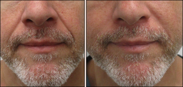 Mini Facelift Before And After