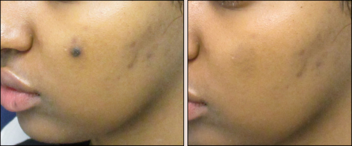 Intradermal Nevus Removal