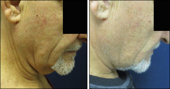 Plastic Surgery Neck Lift Before After Photos- Chicago Face Lift ...