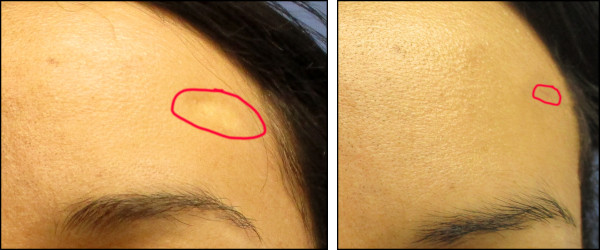 Scar Tissue Excision: Treatment, Symptioms, Cause | Prplastic, Chicago