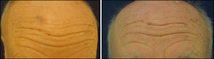 Scar Tissue Excision: Treatment, Symptioms, Cause | Prplastic, Chicago