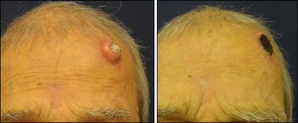 Early Squamous Cell Carcinoma Scalp